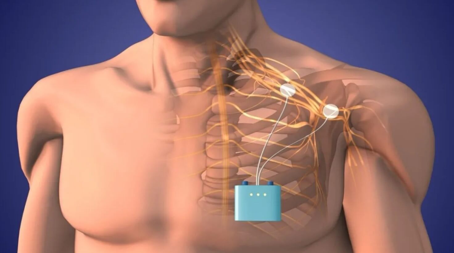 Peripheral Nerve Stimulation Device | Book Your Appointment Now